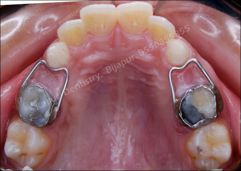 Dentistry for children – Kallur Dentistry